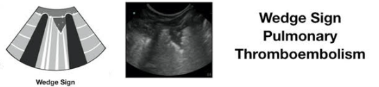Lung Ultrasound for Pulmonary Thromboembolism: The Vet BLUE® Wedge Sign