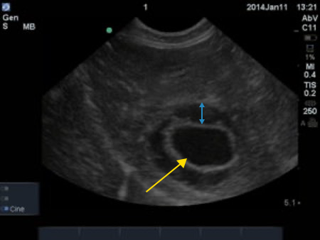 Ultrasound Findings in Anaphylaxis: What the Gallbladder Can Tell Us