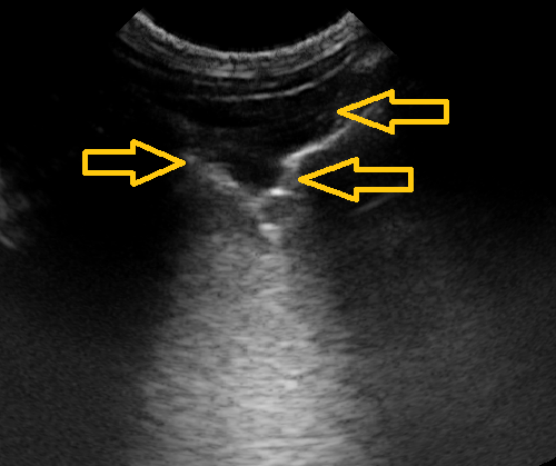 Lung Ultrasound (Fungal Pneumonia) Case Study
