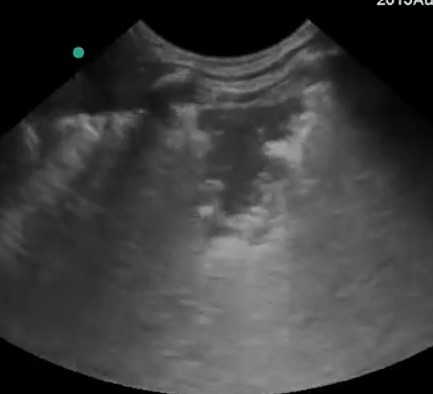 Lung Ultrasound for Pulmonary Thromboembolism: The Vet BLUE® Wedge Sign